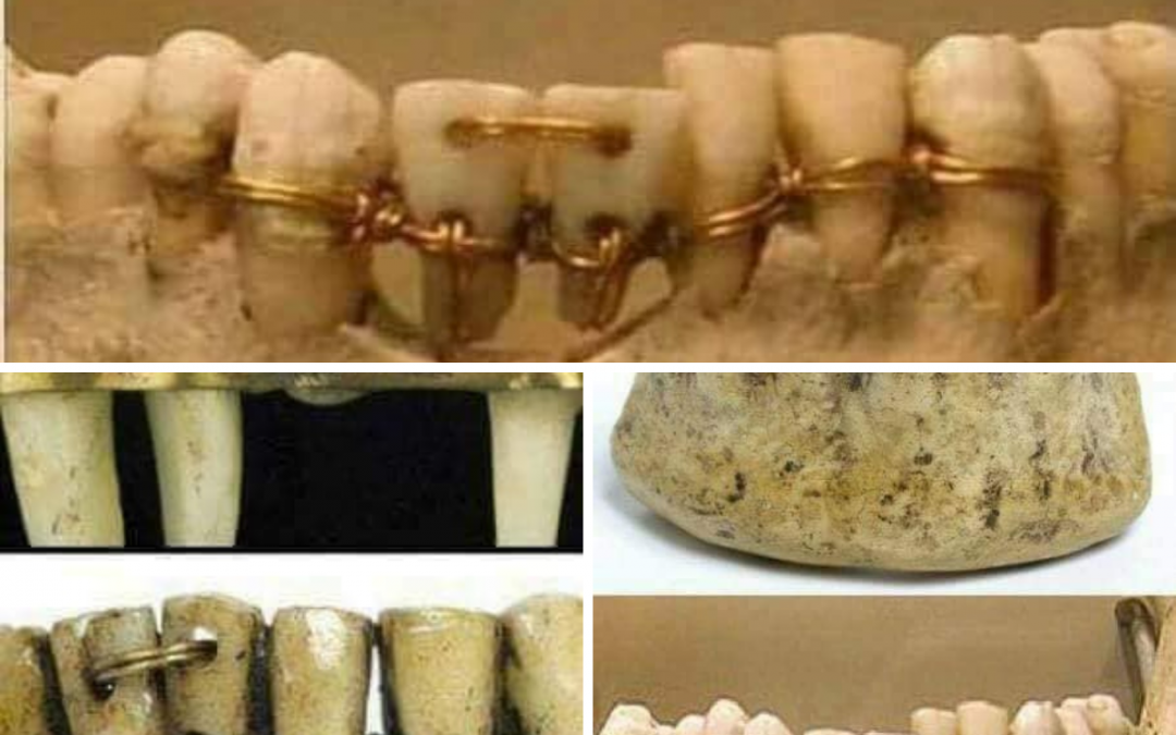 Odontologia Incaica | Extirpacion craneana de los Inca | cirugia Incaica